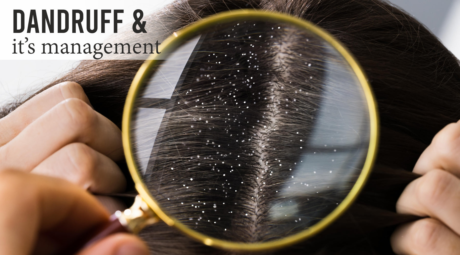 Dandruff | Causes, symptoms and how to get rid of it – Caredura Store