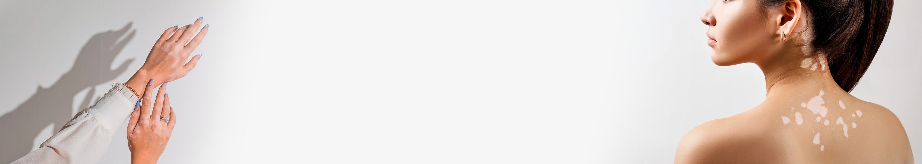 Best Vitiligo Products | A Complete Vitiligo Treatment Kit – Caredura Store